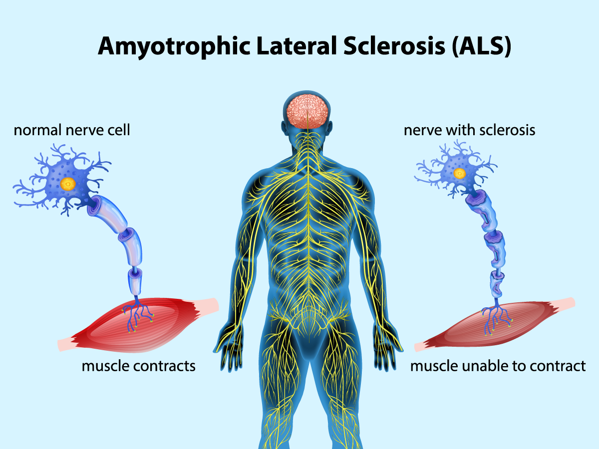 Growing Demand Propels Amyotrophic Lateral Sclerosis Market to Record ...