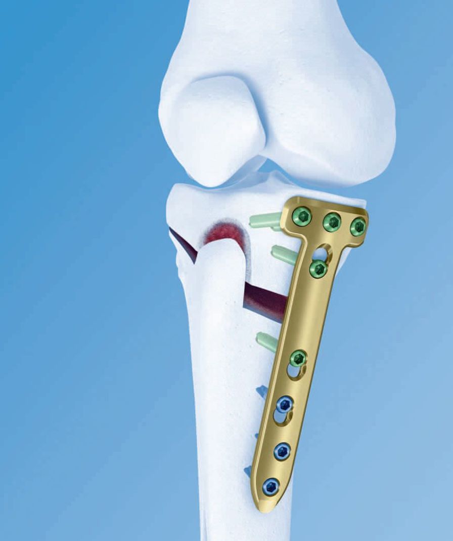 High Tibial Osteotomy (HTO) Plates Market by Technique, Material, etc...