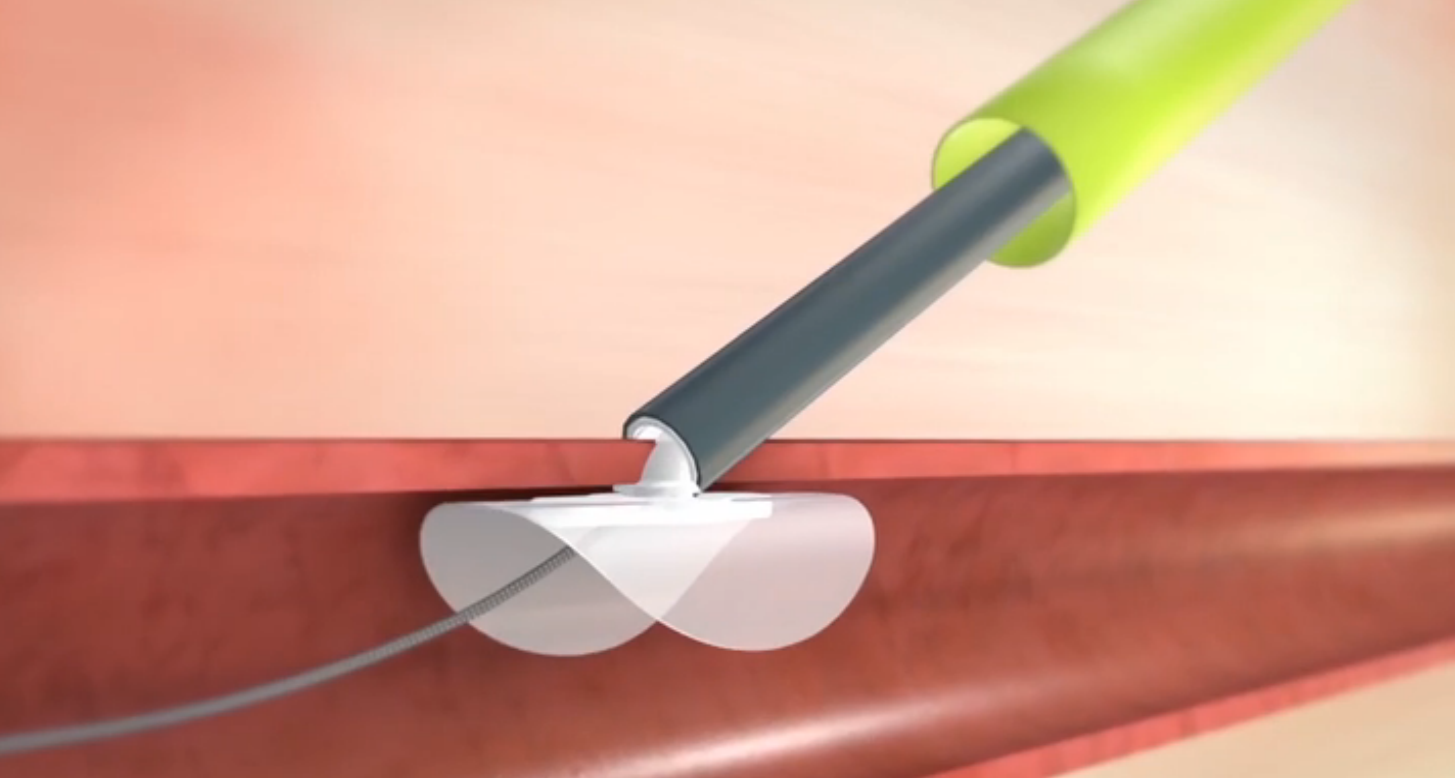 Global Vascular Closure Devices Market to Reach USD 2,466.5 Million by ...