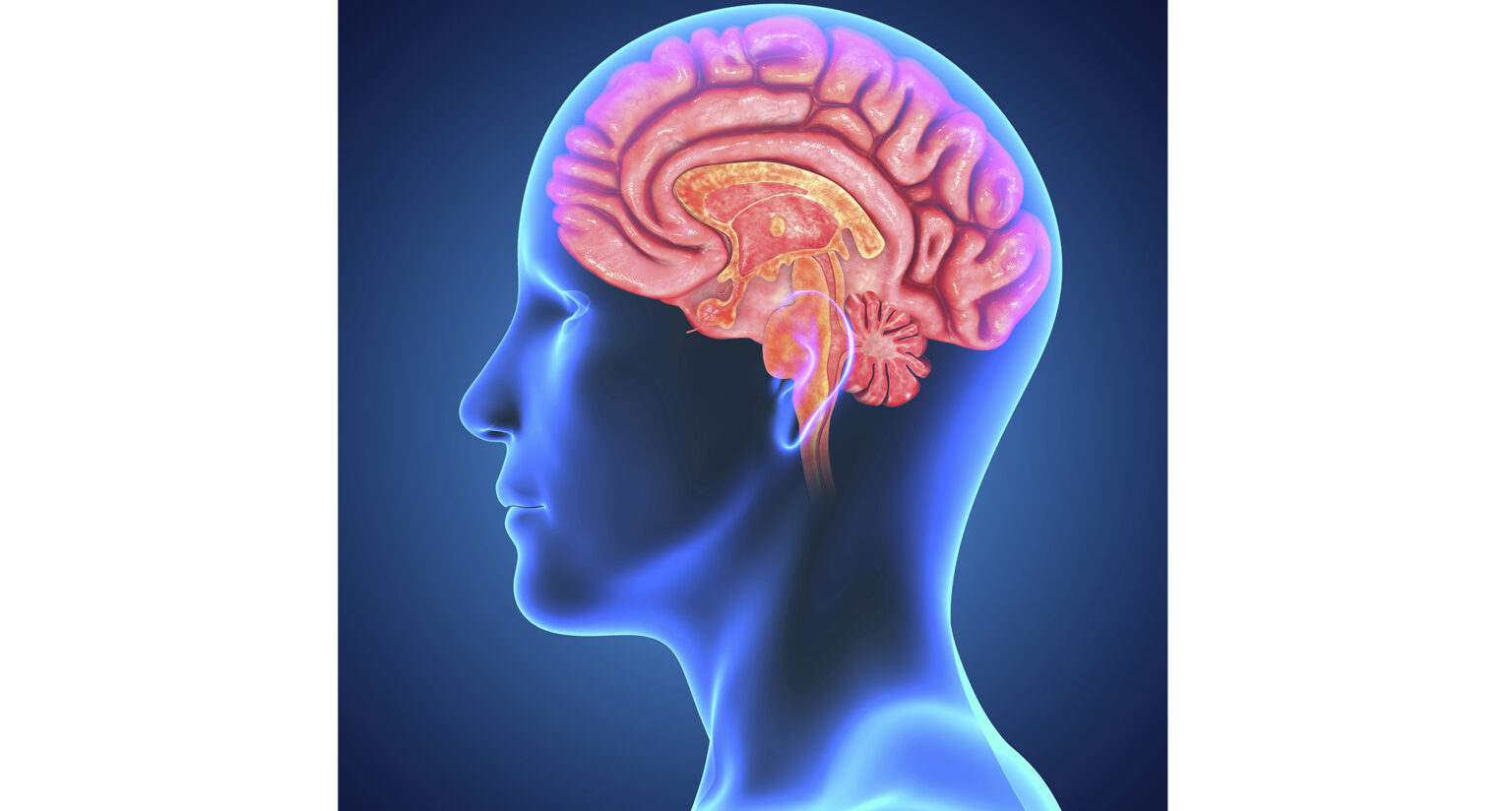 Global Multiple System Atrophy (MSA) Therapeutics Market to Reach USD ...