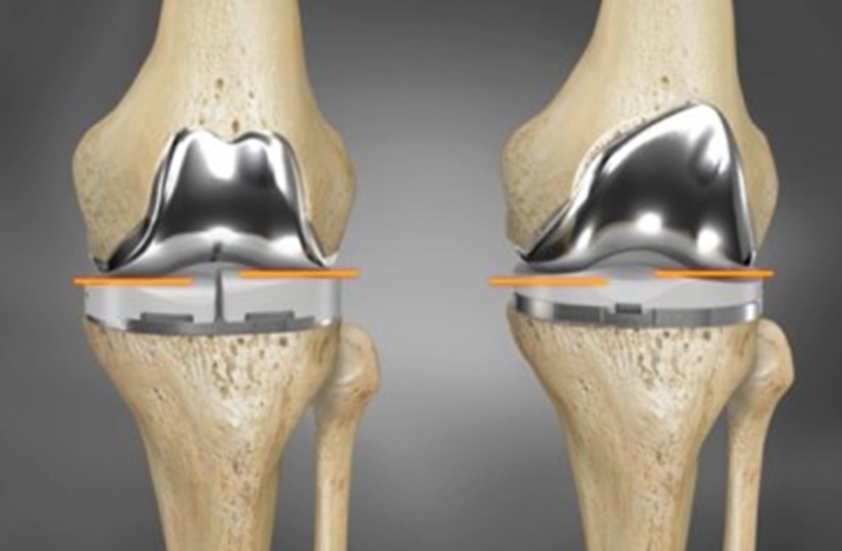 Global Hip and Knee Reconstructive Industry | FMI Inc.