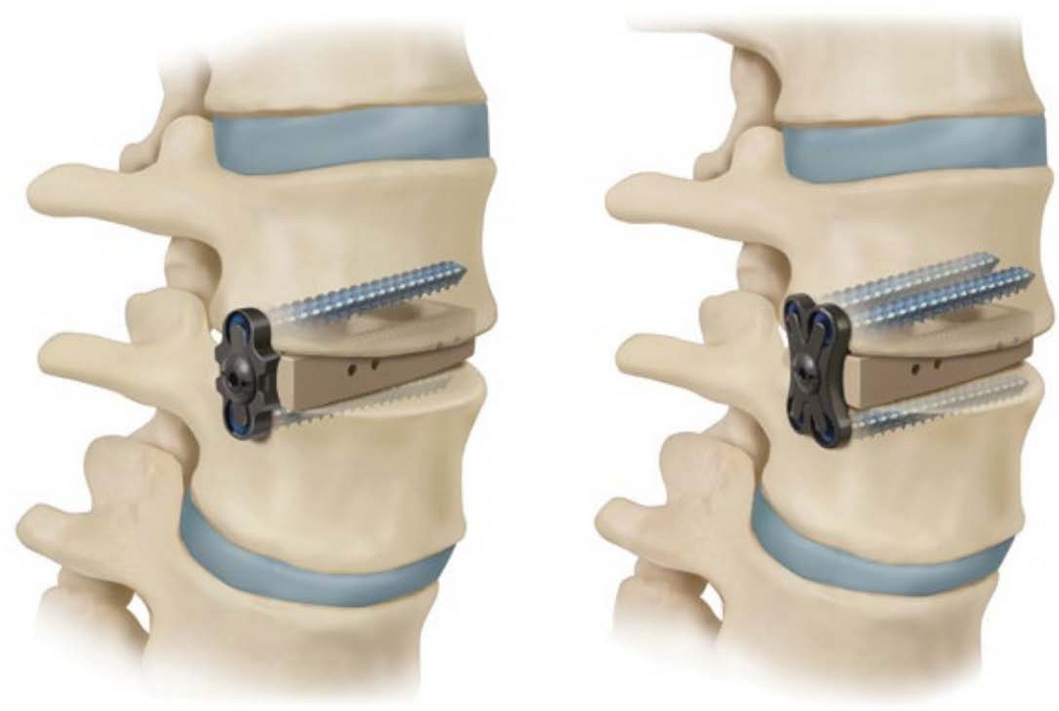 Non-Fusion Spinal Devices Market to Reach USD 6.99 Billion by 2033 at a ...