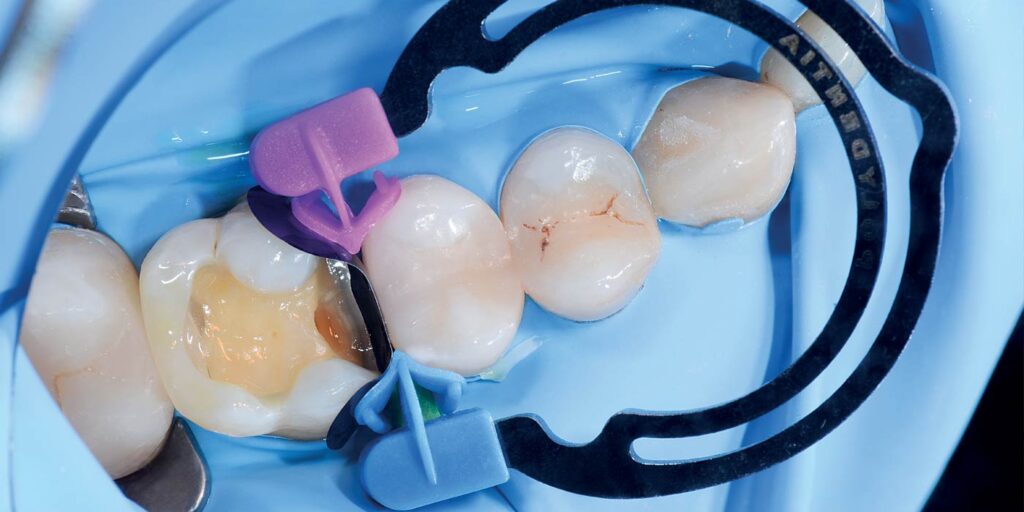 Global Dental Matrix Systems Market Poised for Robust Growth: Projected ...