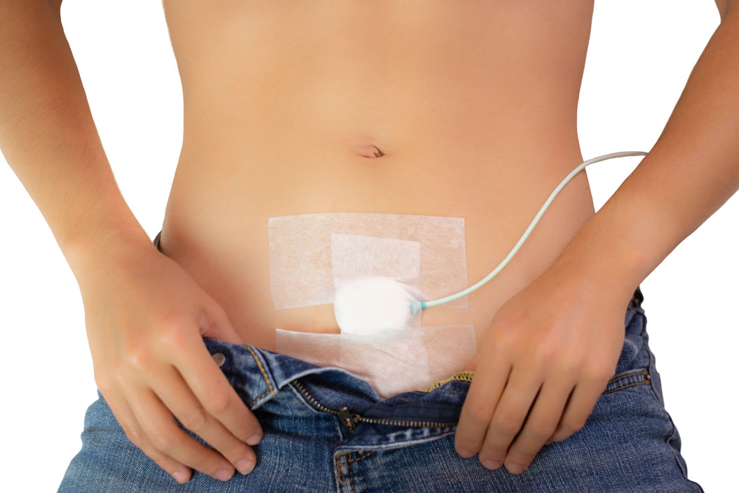 Global Female Stress Urinary Incontinence Treatment Device Industry Is