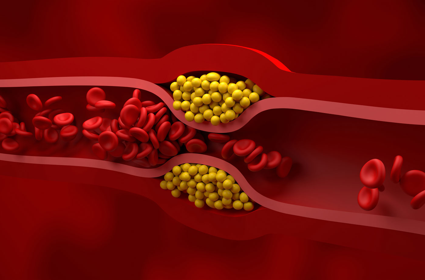Heterozygous Familial Hypercholesterolemia Management Market Projected ...