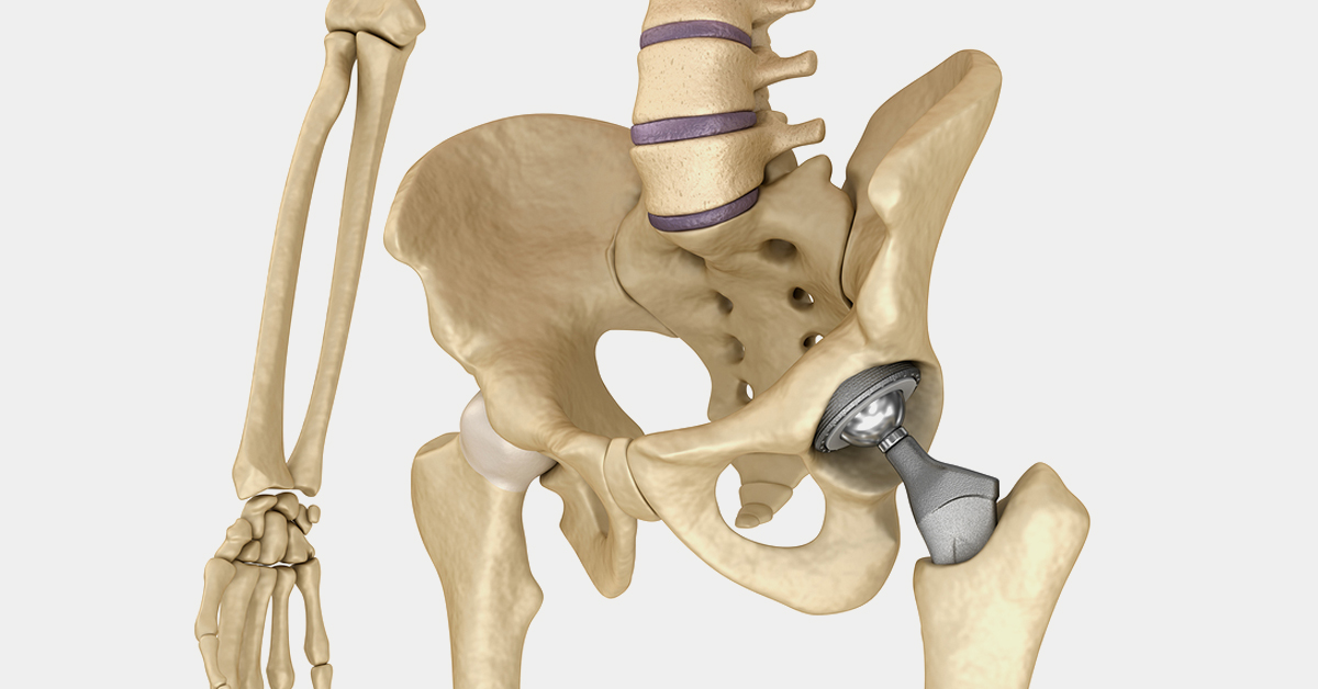 3D Printed Hip and Knee Implants Market to Grow at 7.1% CAGR, Reaching ...