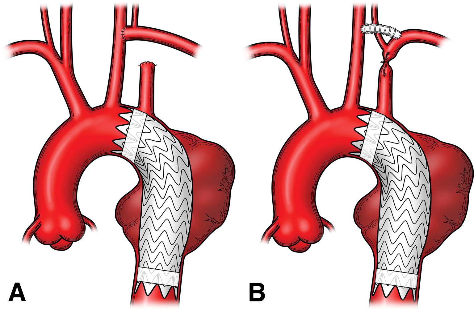Global Aortic Stents Grafts Market to Reach USD 4.2 Billion by 2033 a ...