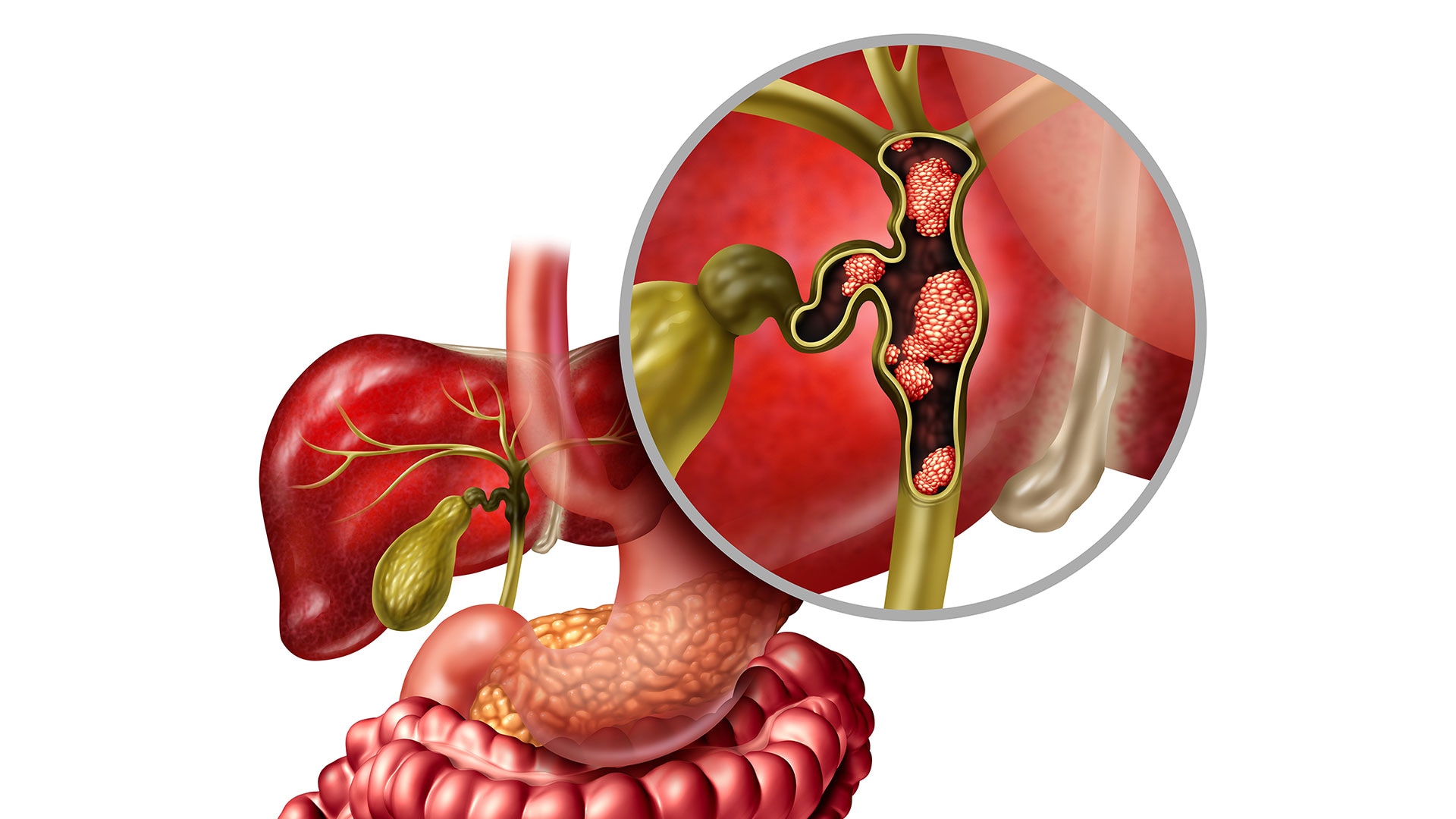 Global Biliary Tract Cancers Treatment Market Set to Surge, Reaching ...