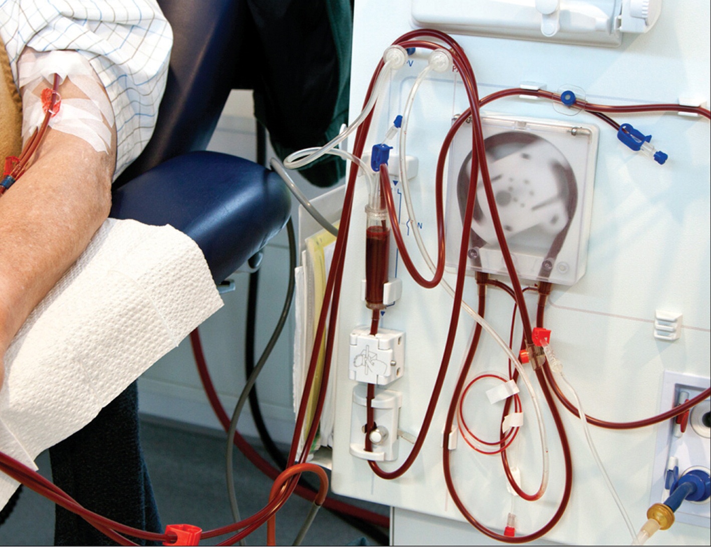 Global Continuous Renal Replacement Therapy Market Set for Exceptional Growth: Projected to ...