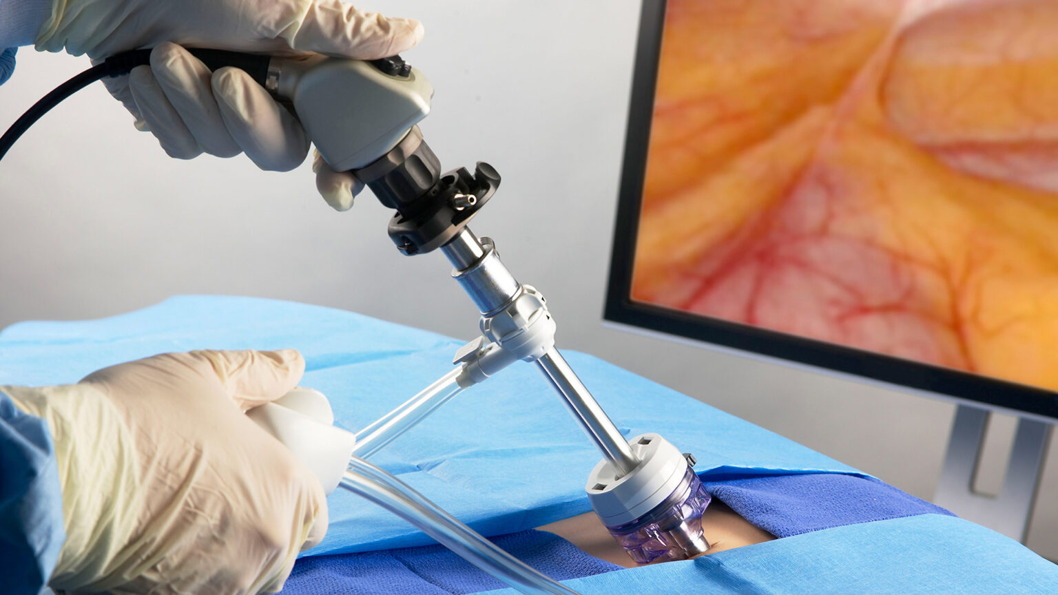 Endoscopic Closure Systems Market Set for Robust Growth Through 2035 ...