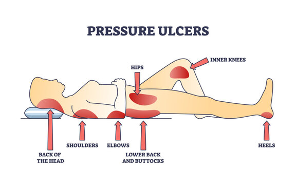 Global Pressure Ulcer Detection Devices Industry Poised for Growth ...